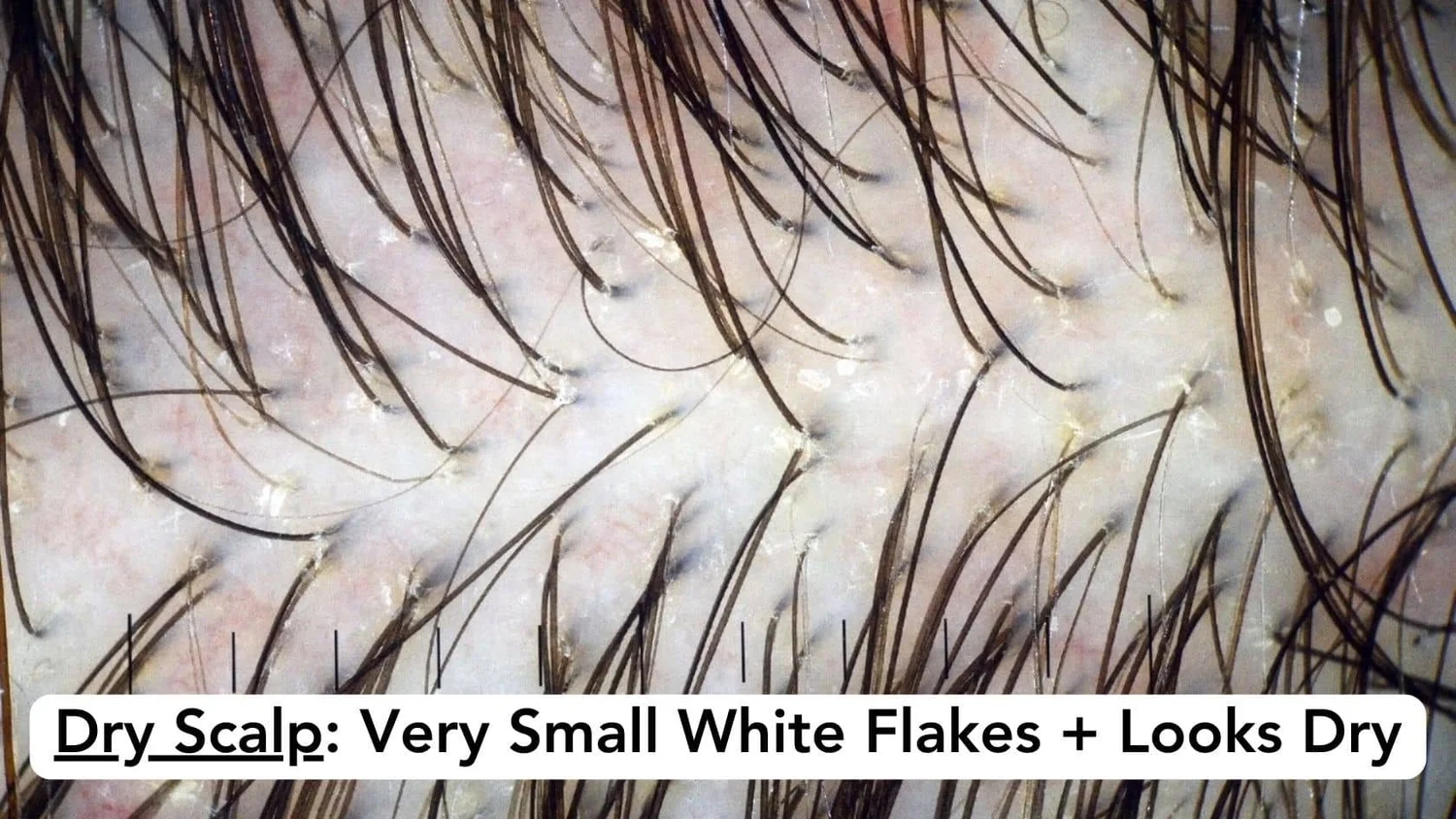 Dry Scalp vs Dandruff: What Kind of Flakes Do You Have?