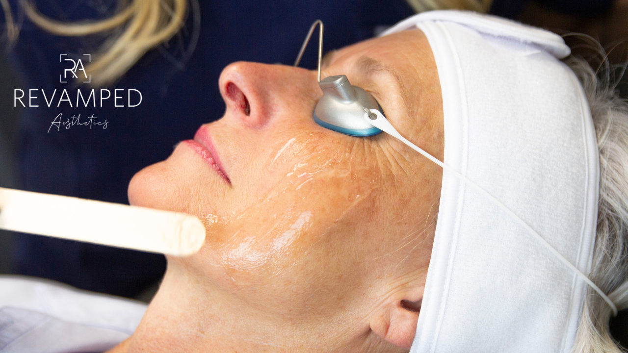 The Best Laser Treatment for Melasma: What You Need to Know