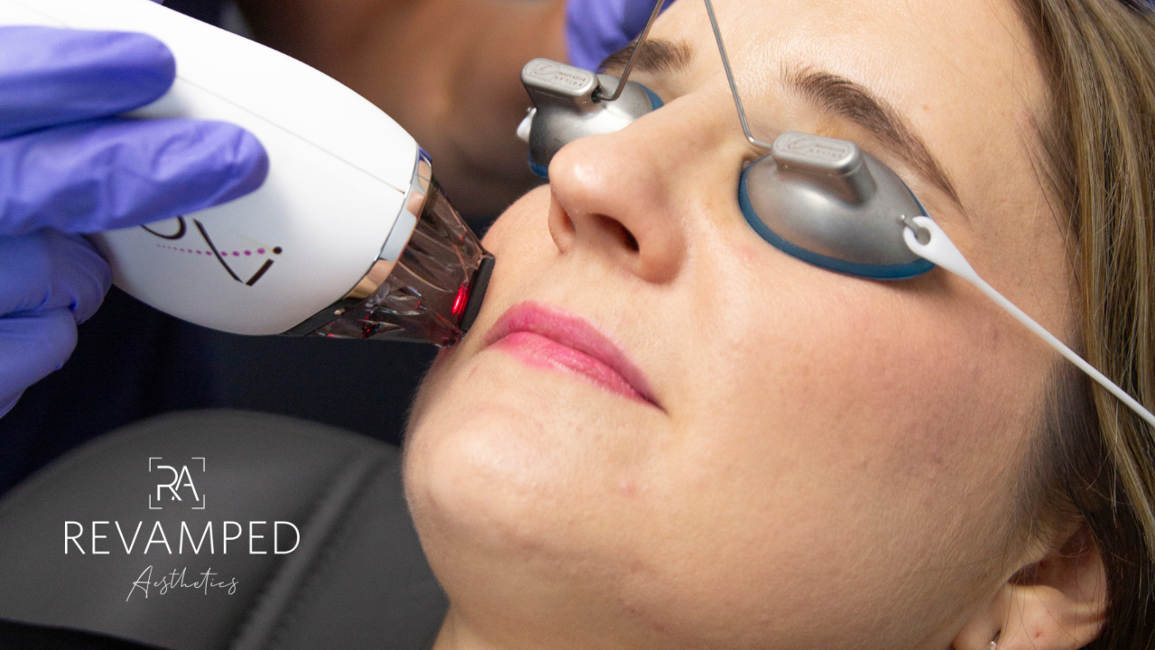 Unlocking Laser Therapy Effectiveness for Melasma - Discover More ...