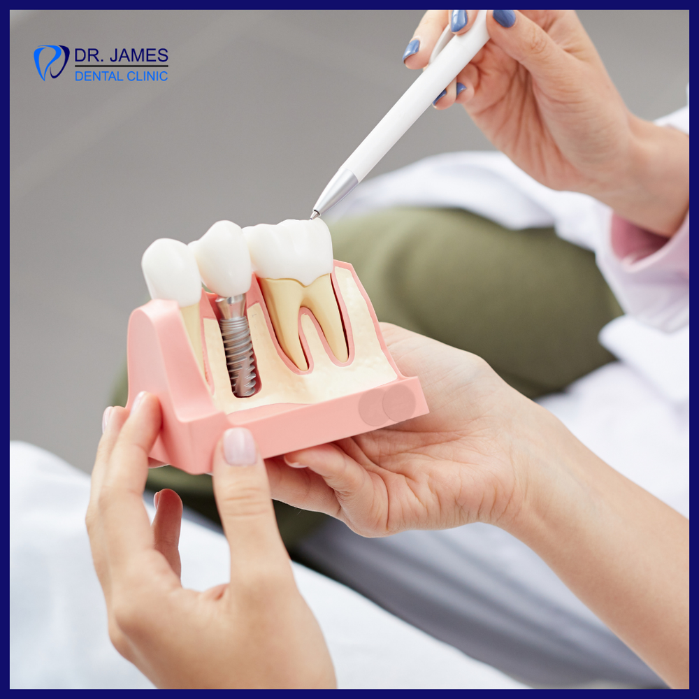 Dental Implant — Dr. James Dental Clinic