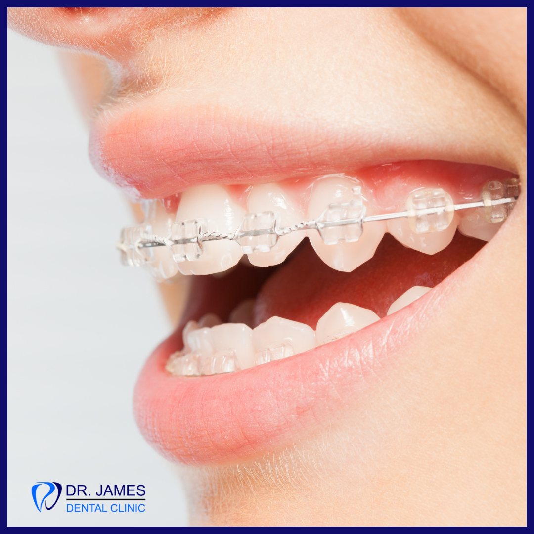 Braces — Dr. James Dental Clinic
