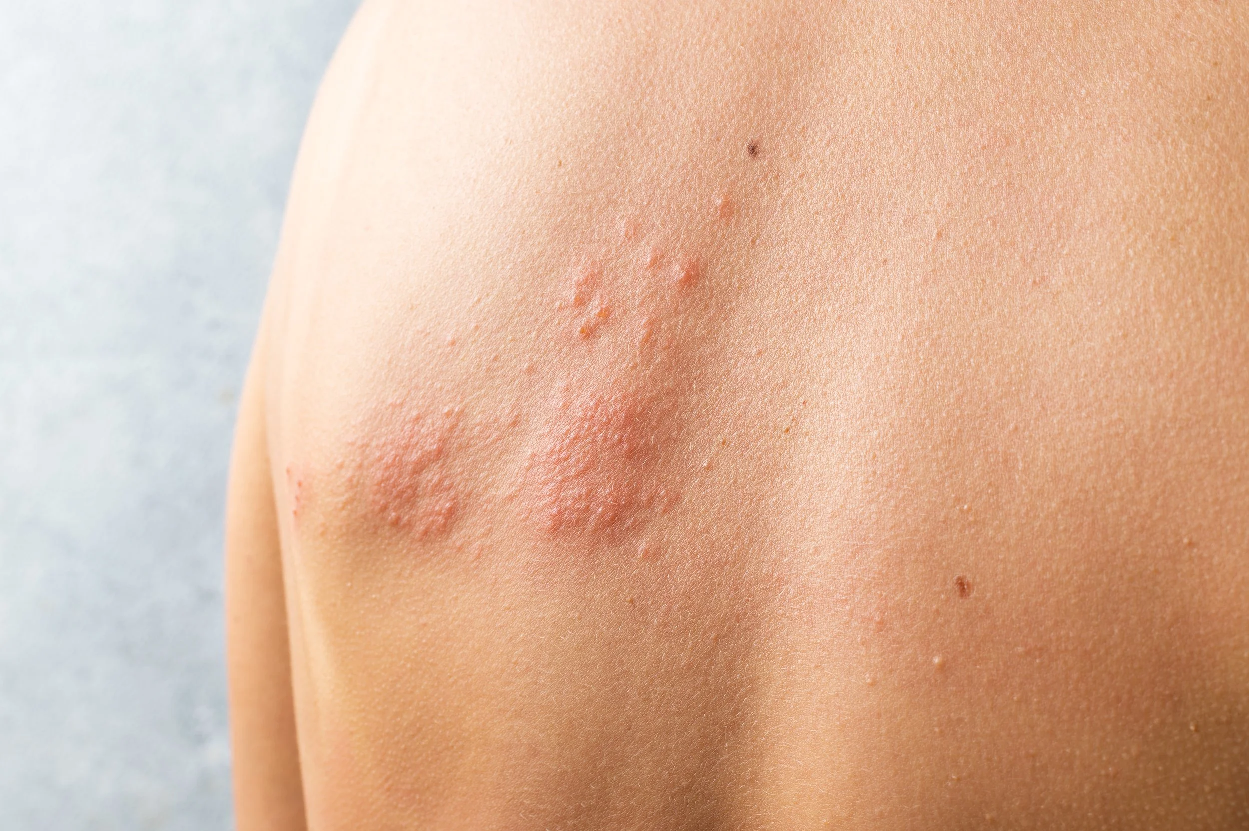 Viral Rashes Brannata Dermatology Viral Rashes Brannata Dermatology