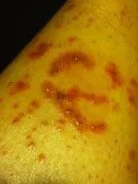IgA Vasculitis (Henoch-Schönlein Purpura) — Vasculitis Ireland ...