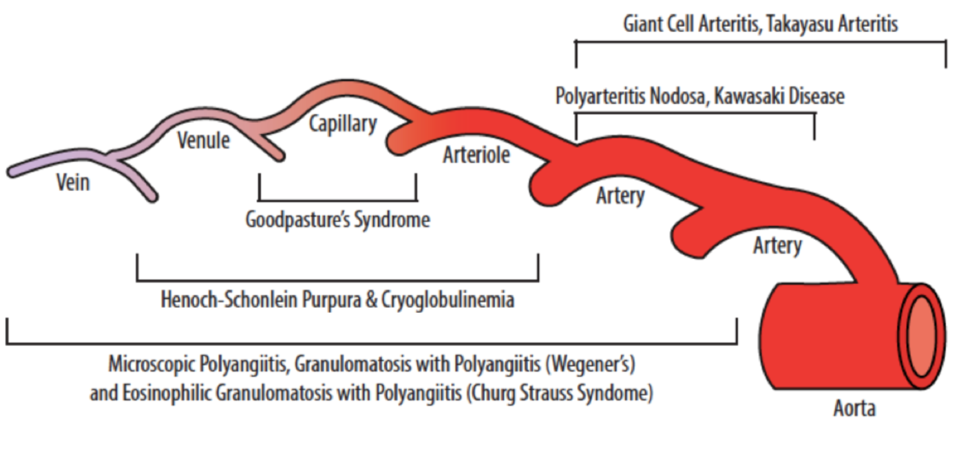 What is Vasculitis — Vasculitus Ireland — Vasculitis Ireland Awareness ...
