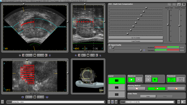 HIFU Treatment for Prostate Cancer | University Urology