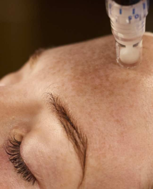 Microneedling Facial London, Marylebone | Microneedling (Skinpen) For ...