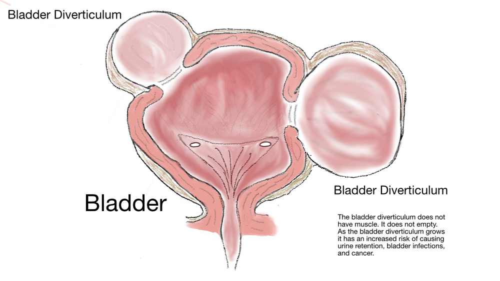 Bladder Diverticulum Urology Patient Education by Dr Todd Brandt