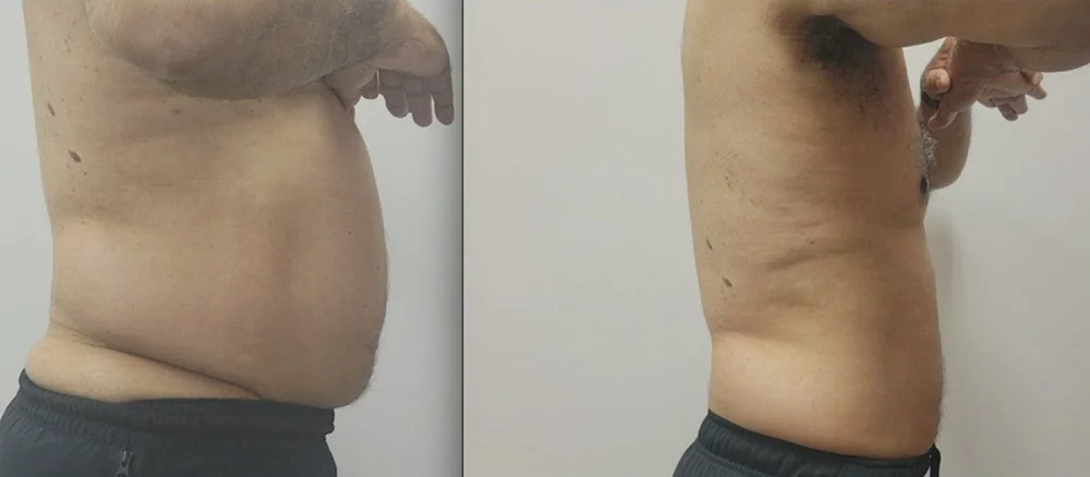 Non-Invasive Fat Reduction with Ultraslim — Beautiful Body Medspa