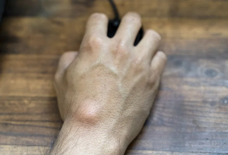 Skin Lesions Surgery — Dr Jason Jay Wong | General Surgeon Endoscopist ...