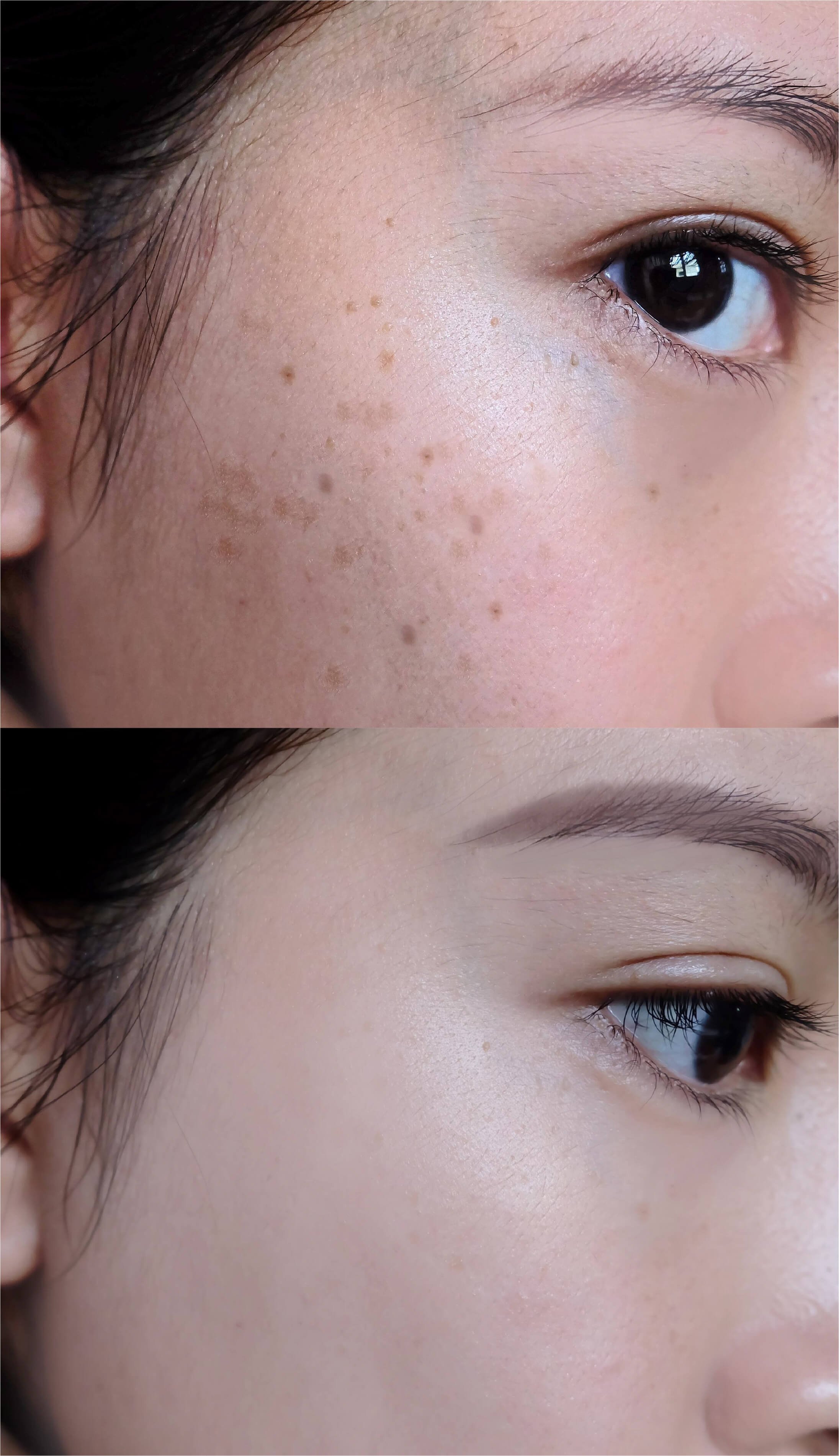 Cryopen Mole and Lesion Removal - Advanced Aesthetic Treatment | Harley ...