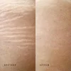 Understanding Stretch Mark Tattoos | Harley Street Injectables - London