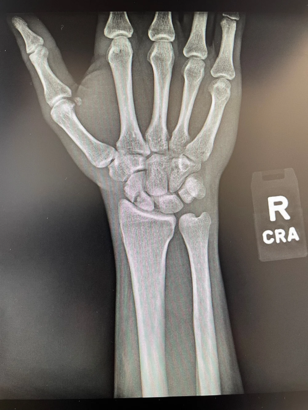Scaphoid Fracture — David Holt, M.D.