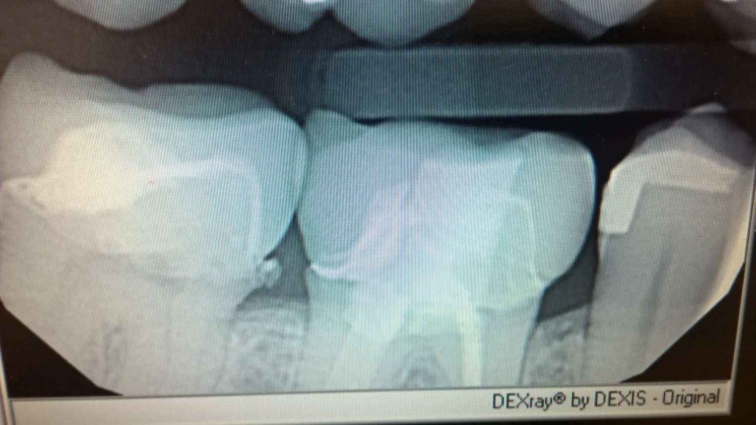 The Easy Way To Remove an Overhang — Welcome to Hygiene Edge