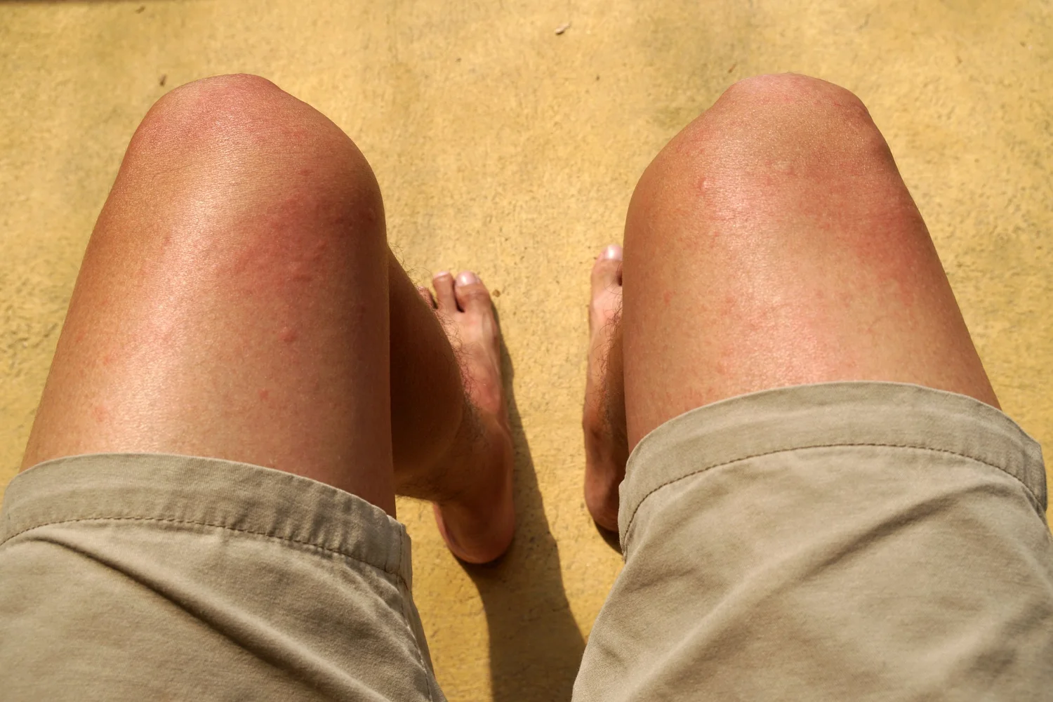 Conditions Treated — Alta Dermatology | Mesa, AZ Dermatologists