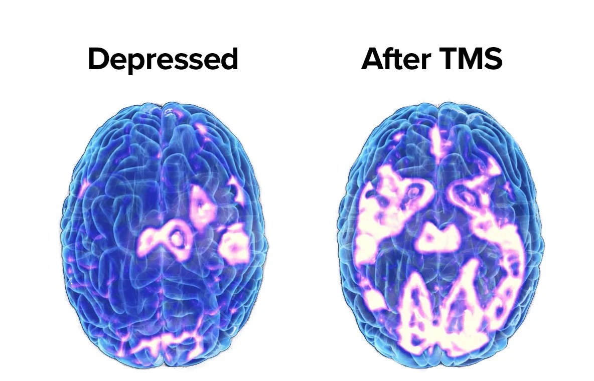 TMS Therapy Insurance Coverage: A Comprehensive Guide — Westside ...