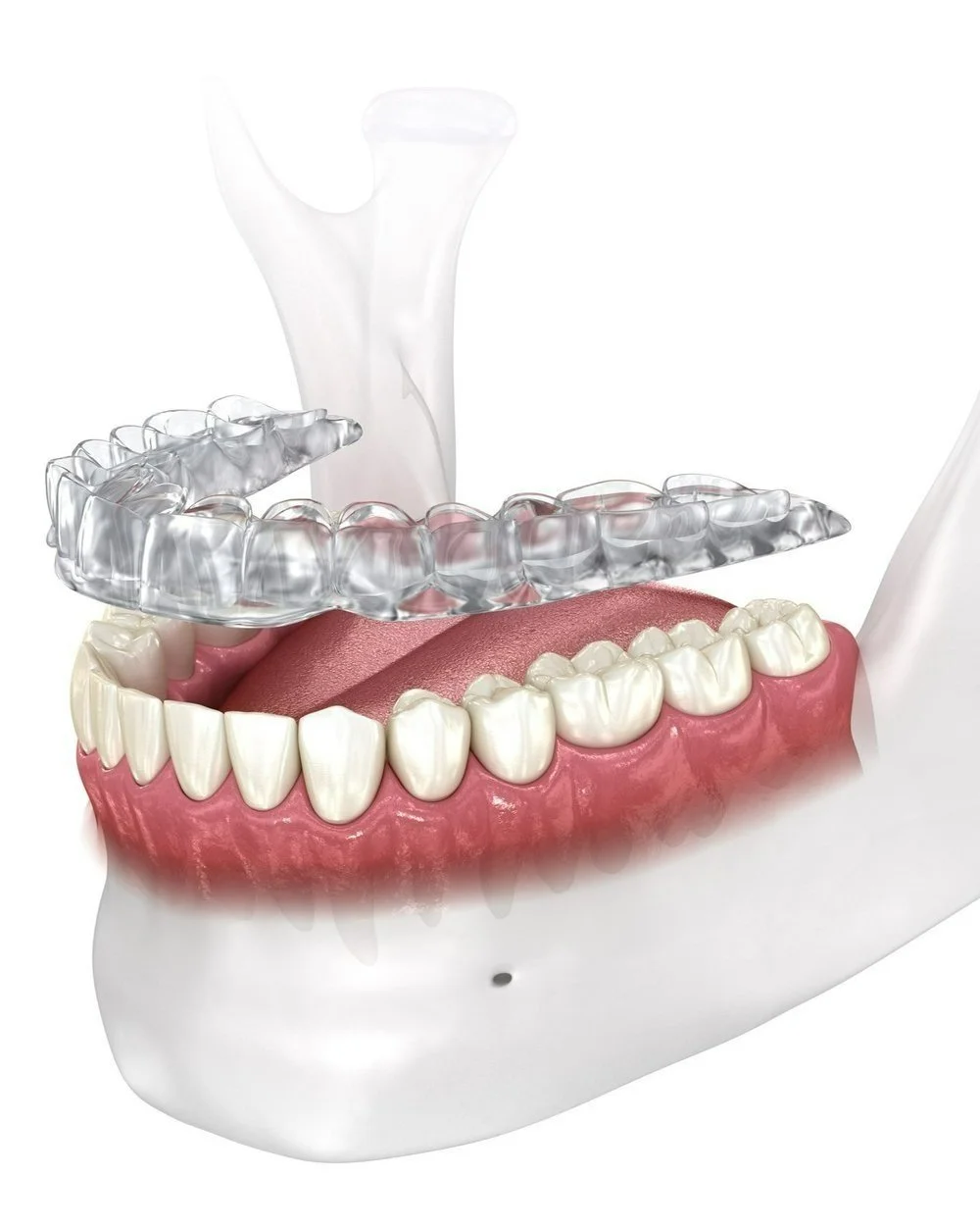 Nightguard and Bruxism — Oak Ridge Dental