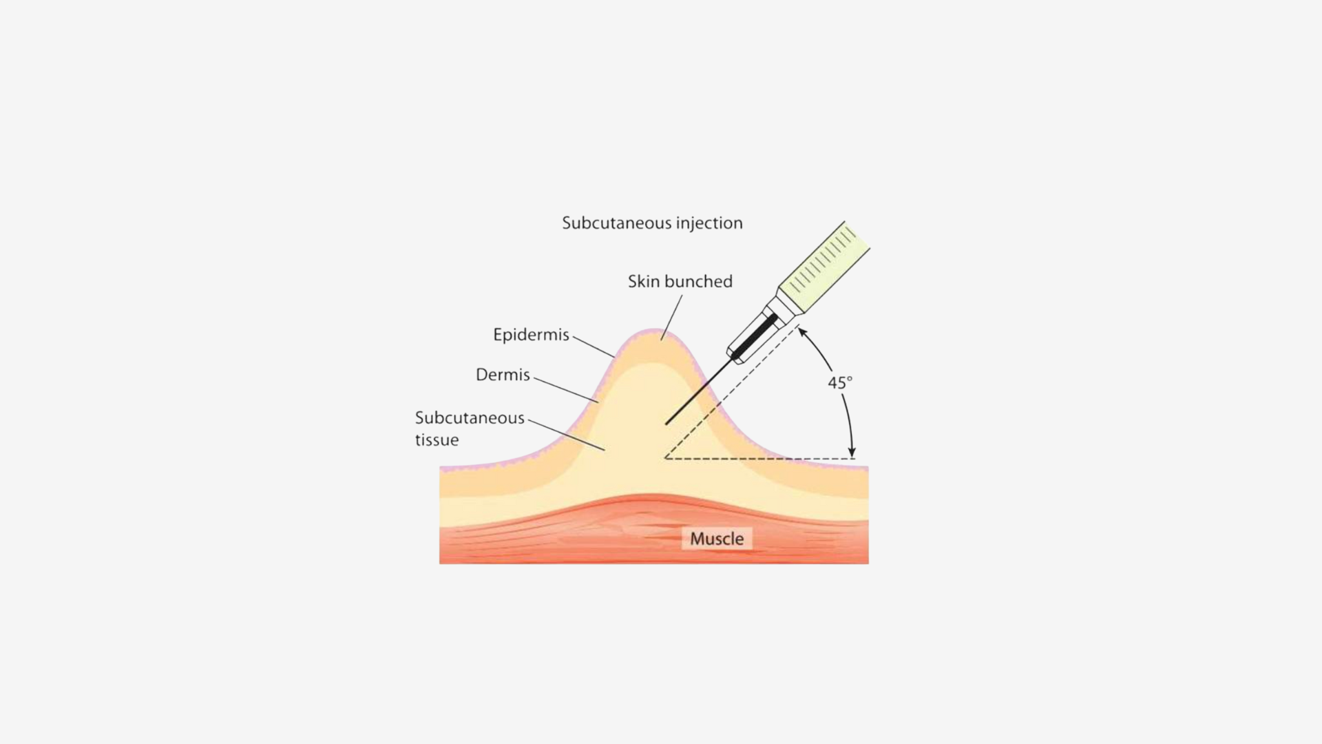How to Give Yourself a Subcutaneous Injection Safely — Dr. Gail King ...