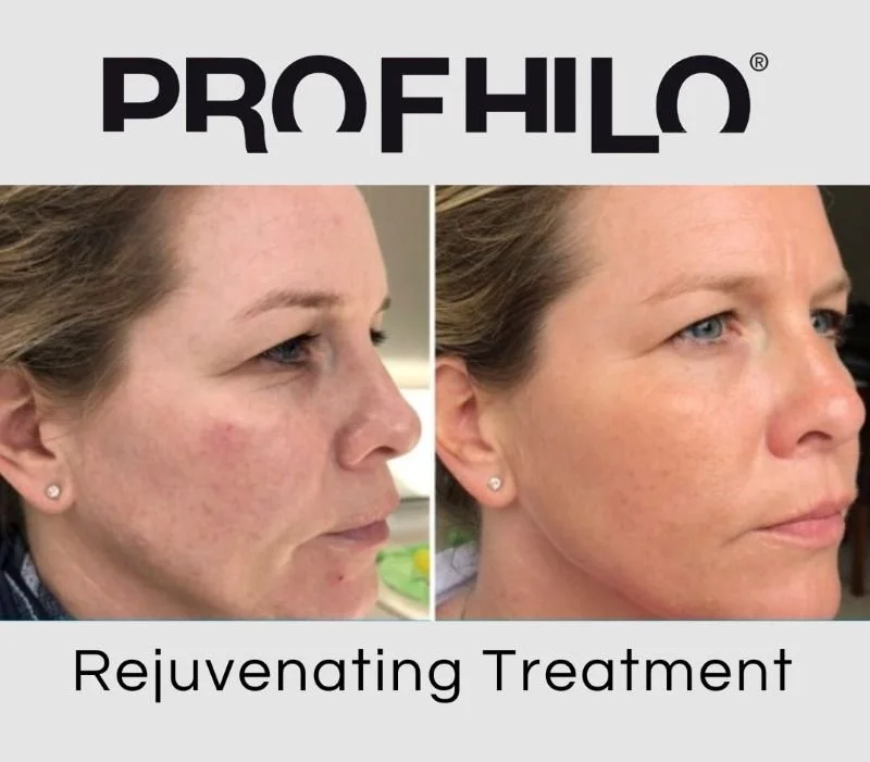 Treatment Spotlight: The Summertime Skin Hero, Profhilo — Nurse Emma Kyte