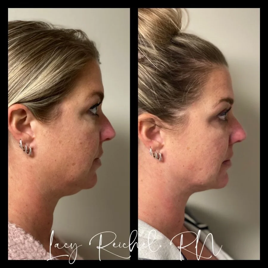 Injectables BOTOX DYSPORT LIP FILLER — Revival Aesthetics MedSpa