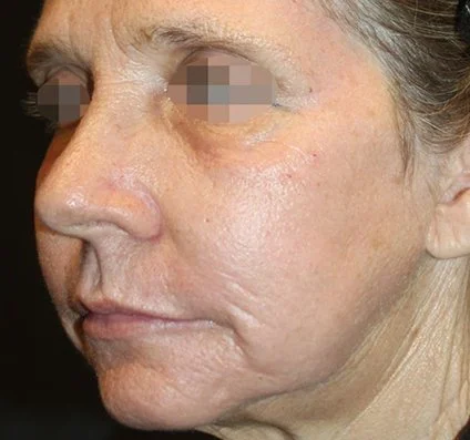 Skin tightening & reducing sagging skin — BY GOLDEN