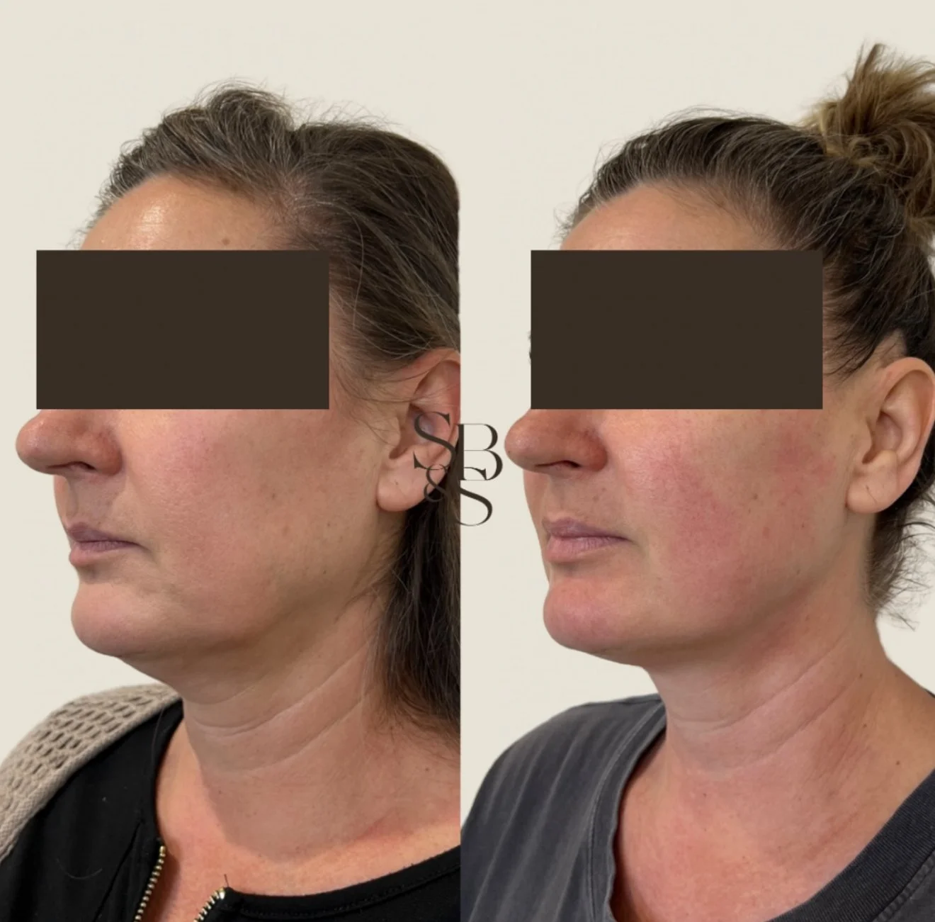 Sculptd Body & Skin | HIFU & Fat Freezing Perth | Inglewood