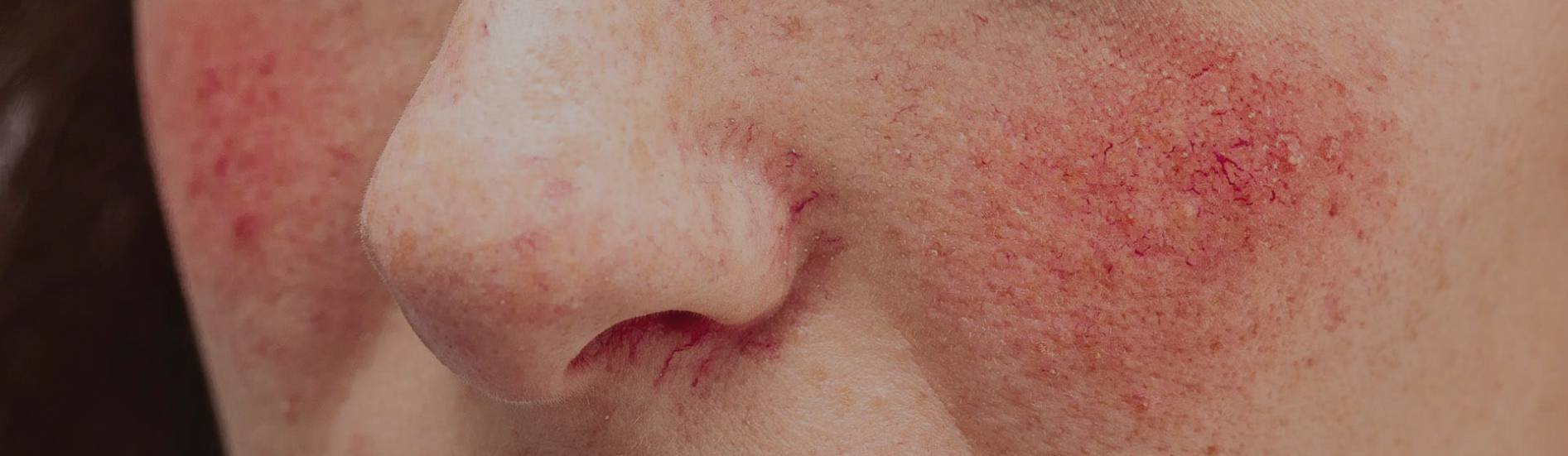 Laser Thread Vein / Rosacea Removal in Bexhill, East Sussex — THE INDIA ...