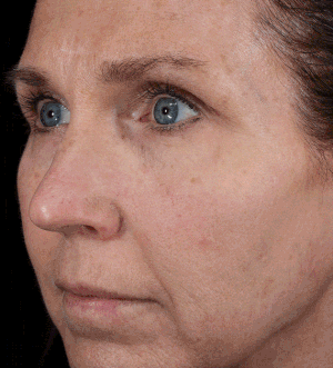 Visia Skin Analysis | Advanced Imaging for Dermatological Analysis ...