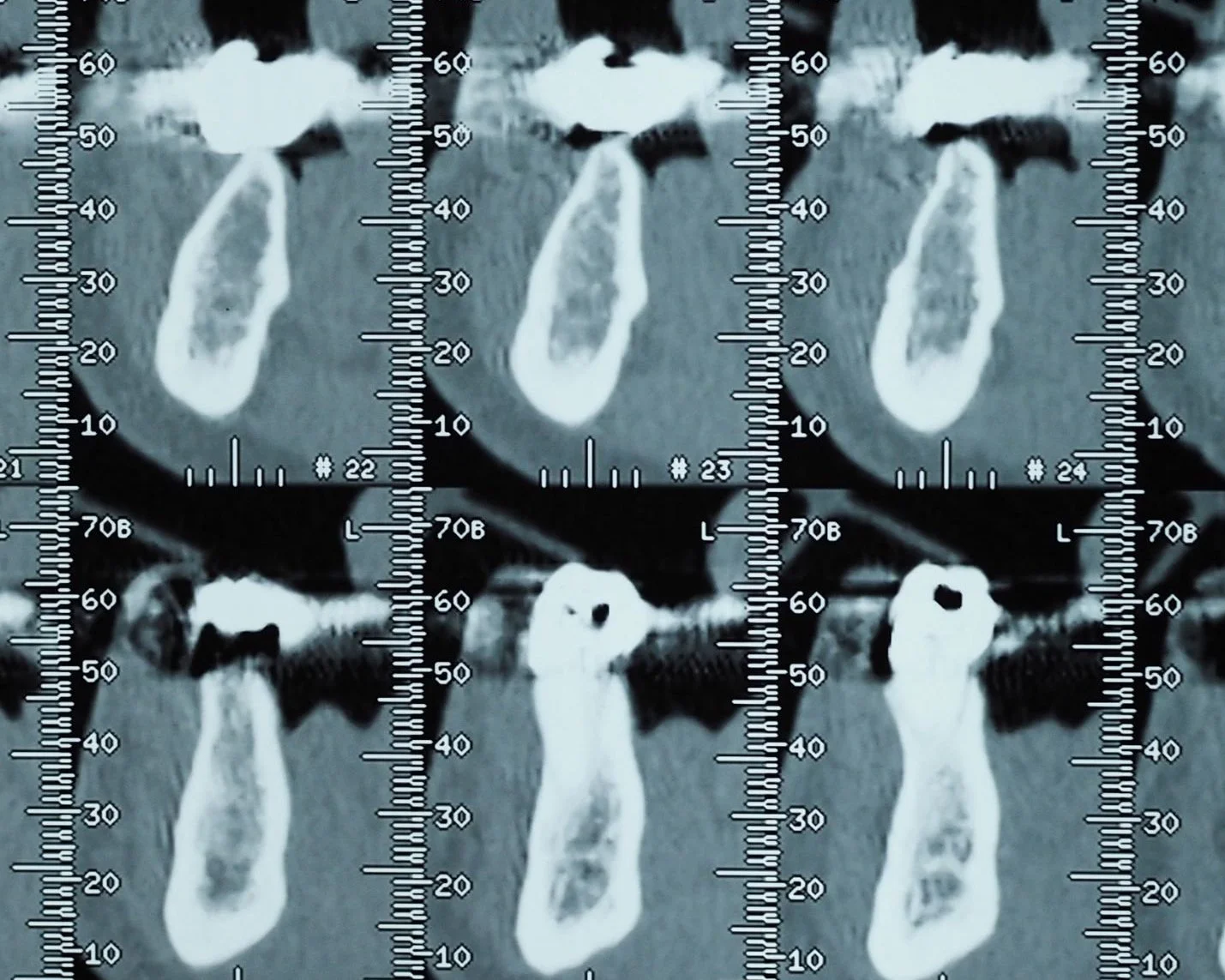 Jaw Bone Cavitations — White Sands Holistic Dentistry