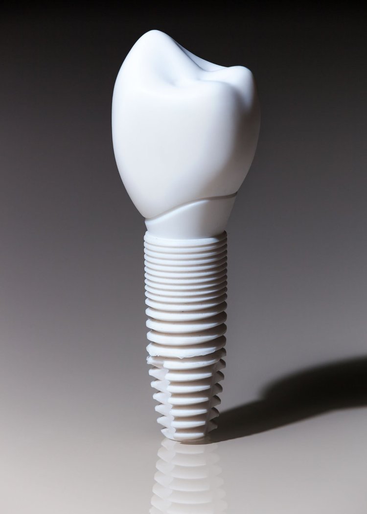 Swiss Dental Ceramic Implants — White Sands Holistic Dentistry