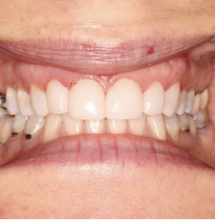 BioClear Dental Restorations in Boulder | Preserve Your Natural Smile ...