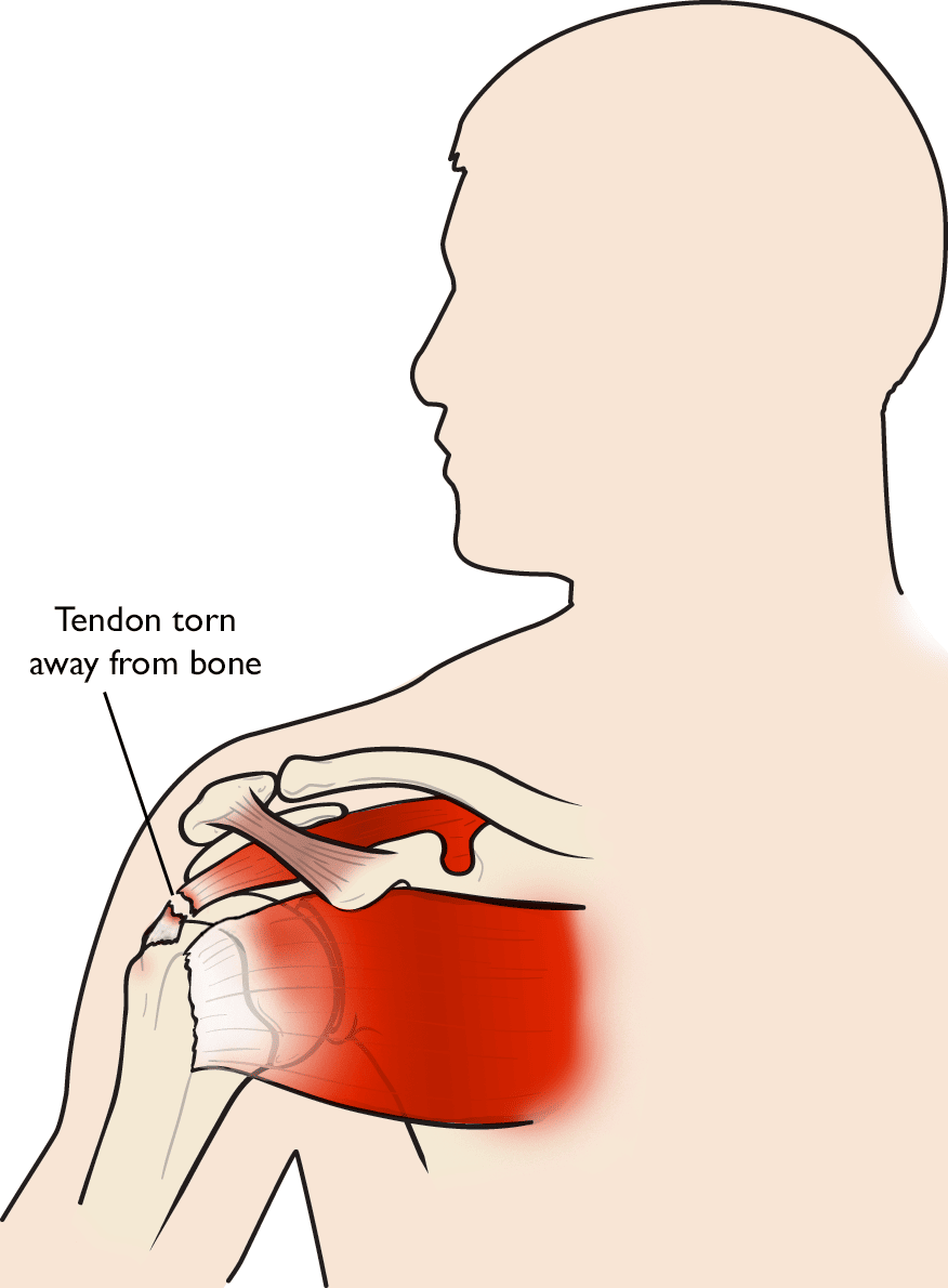 Understanding Rotator Cuff Tears: When Shoulder Pain Shouldn’t Be ...
