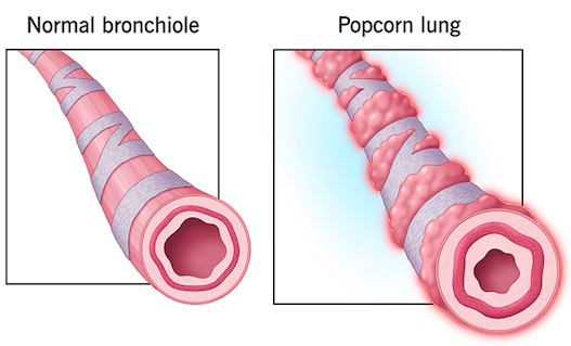 What is Popcorn Lung? — iMaster Health
