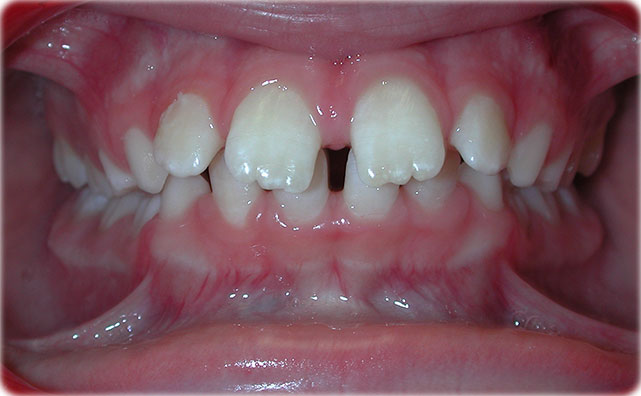 Phase 1 Treatment — Chula Vista Orthodontics