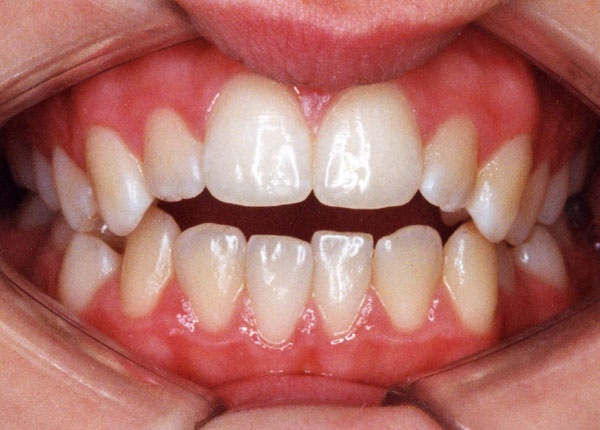 Phase 1 Treatment — Chula Vista Orthodontics