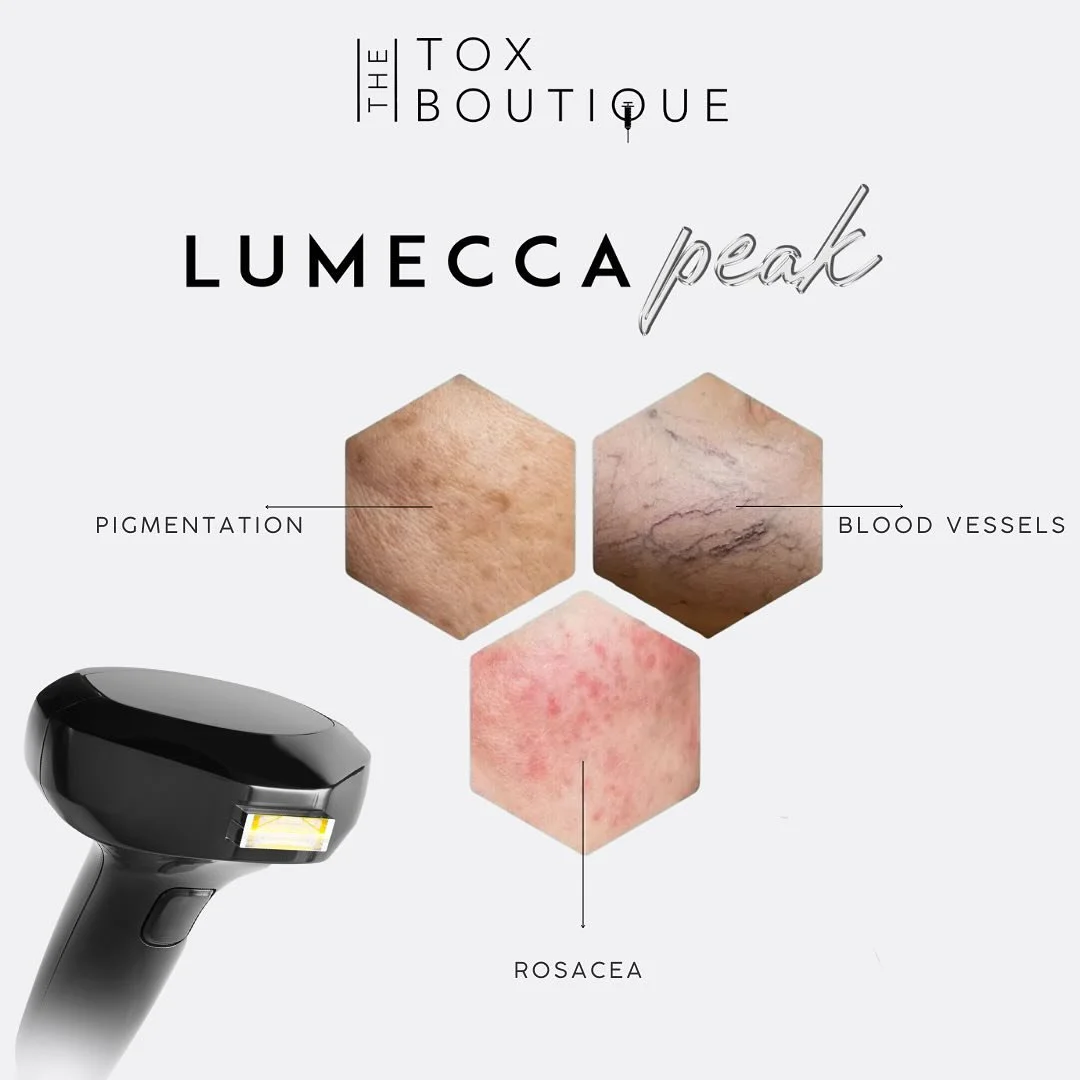 Lumecca Peak: Most Powerful IPL Treatment for Pigmented & Vascular ...