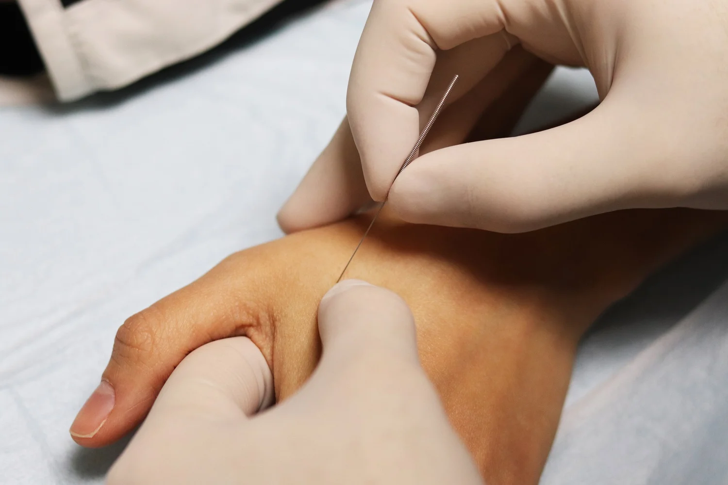 Elevate Dry Needling