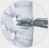 Prodisc®L Anterior Lumbar Total Disc Replacement — Invictus Medical