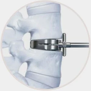 Prodisc®L Anterior Lumbar Total Disc Replacement — Invictus Medical