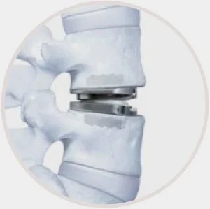 Prodisc®L Anterior Lumbar Total Disc Replacement — Invictus Medical