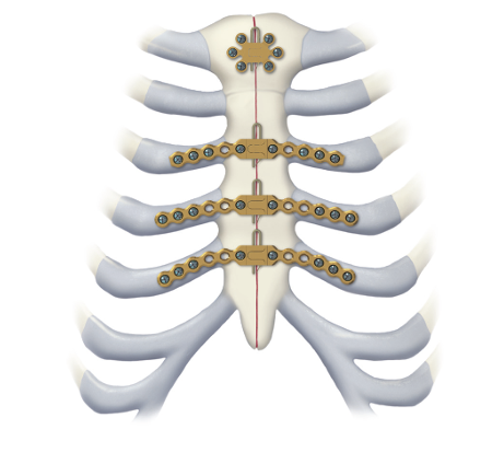 Sternal Fixation: A New Hope for Post-Open Heart Surgery Recovery in ...
