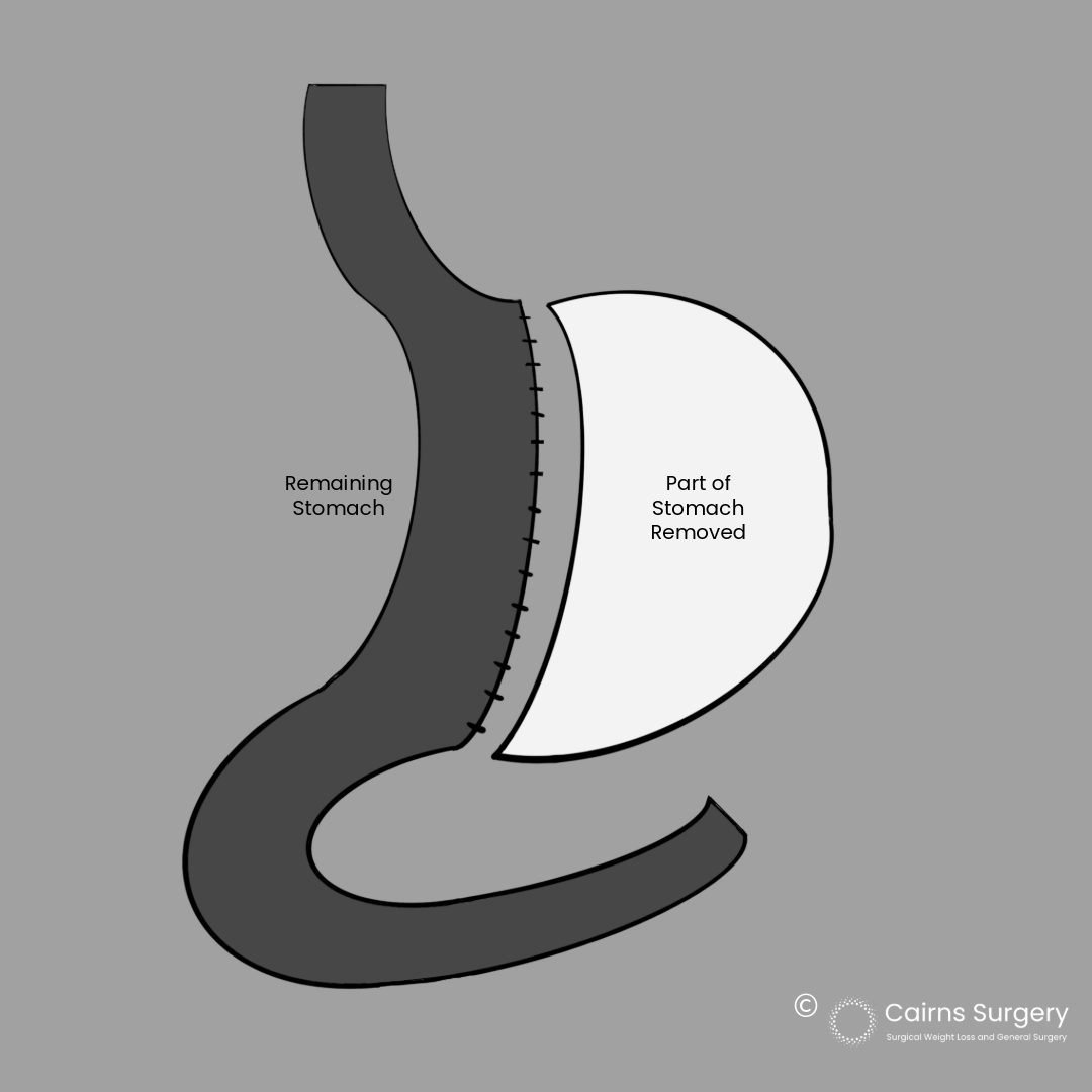 Sleeve Gastrectomy — Cairns Surgery | Dr Delendra Wijayanayaka ...