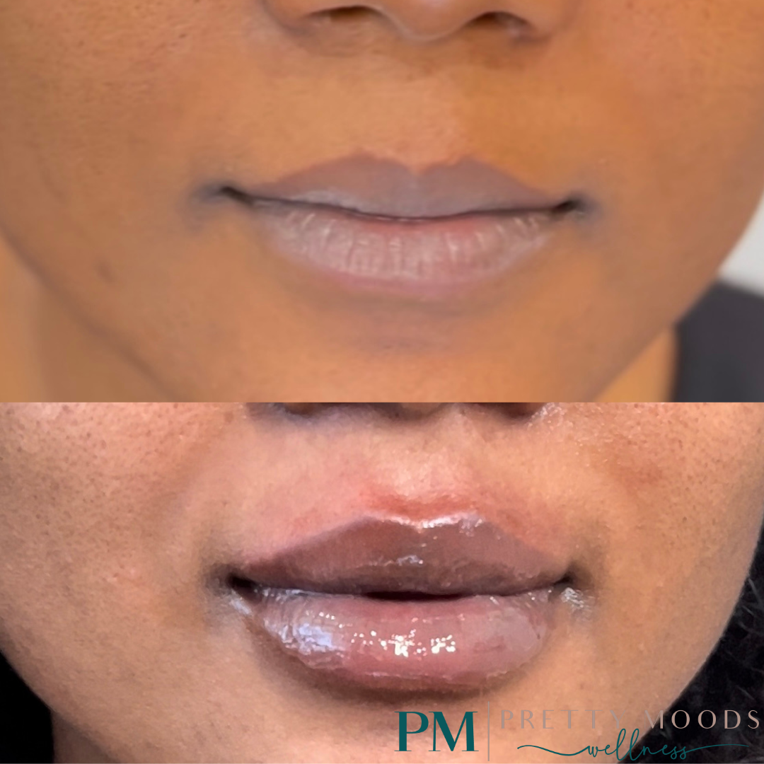 Before & Afters Pretty Mood Wellness | Casselberry, FL 32707 — Pretty ...