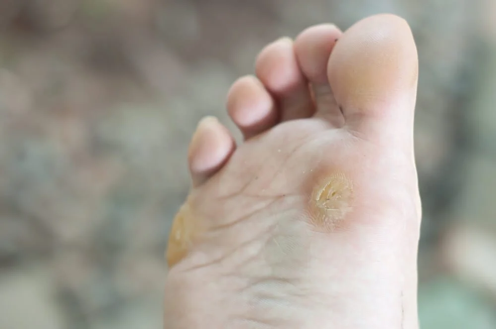 How to Treat Painful Corns and Calluses — Dyker Park Footcare, PLLC