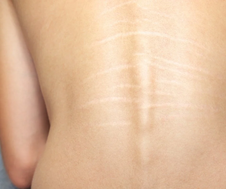 Stretch Marks and Scar Reduction at Joules Medspa & Laser Center in ...