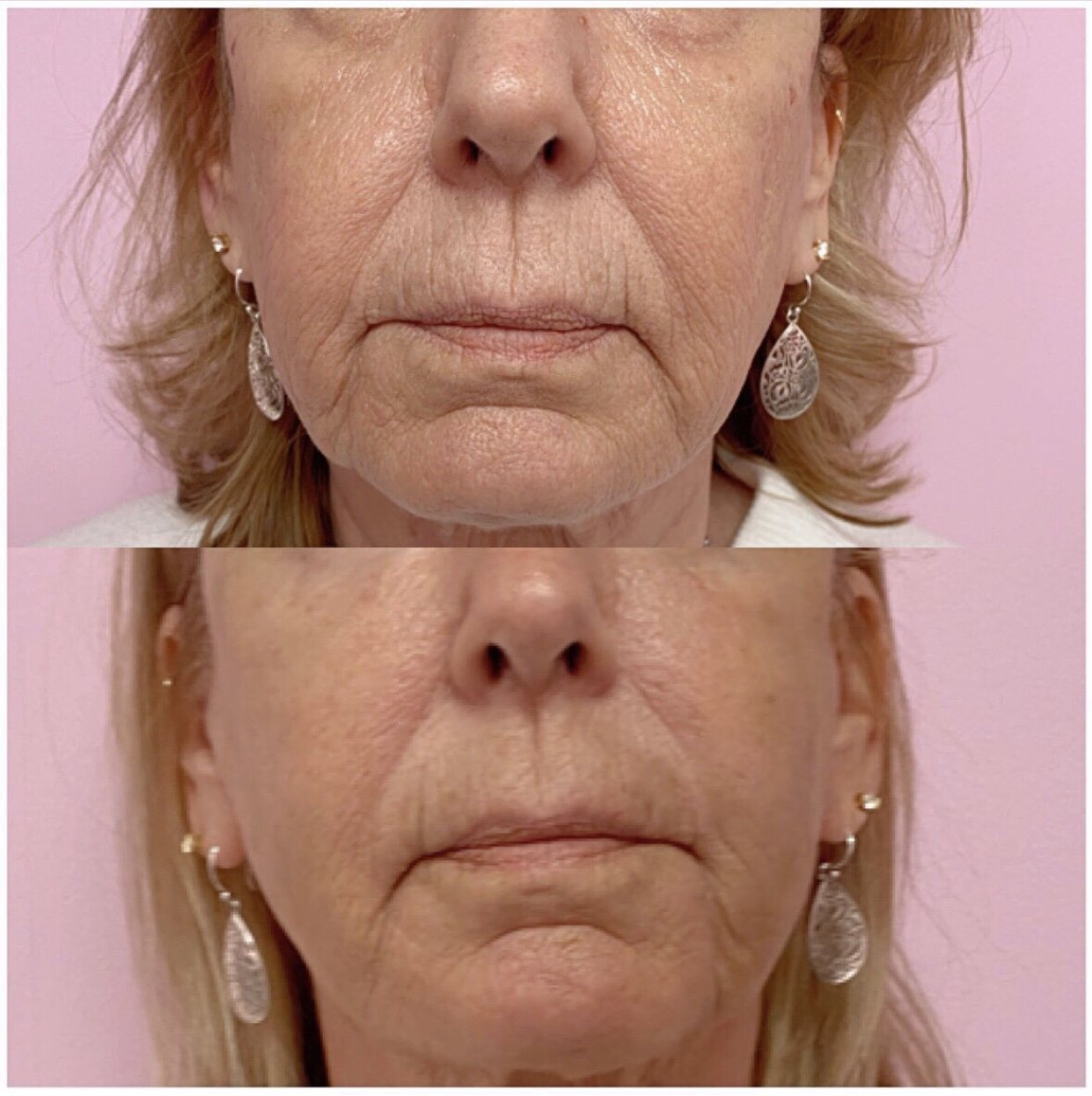PDO Thread Lifting and Facial Contouring — SanaVitta Wellness Center ...