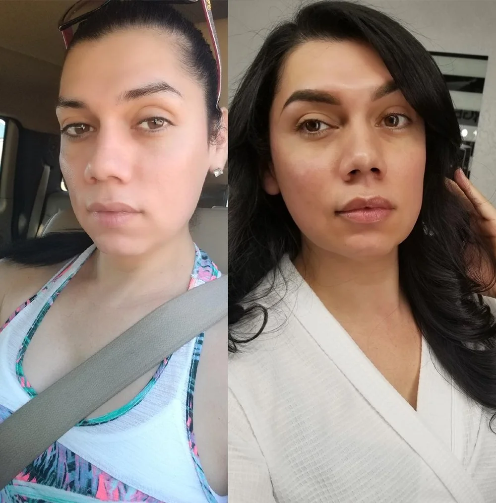 Lip Flip at Joules Medspa & Laser Center in Apple Valley, MN ...