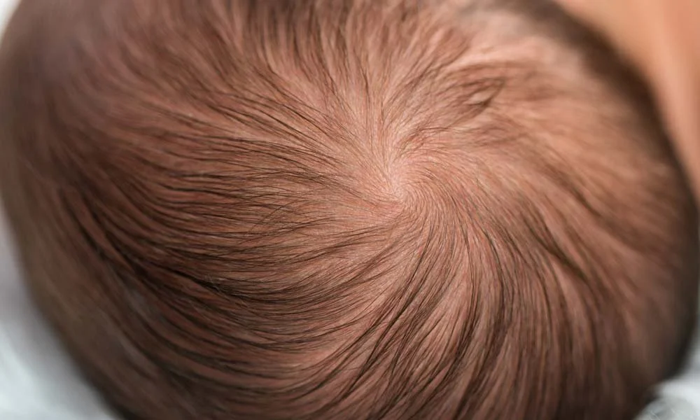 Cradle Cap (Seborrheic Dermatitis) | Treat Sensitive Baby Skin Today ...