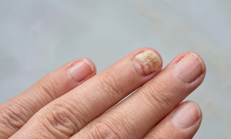 Fungal Infections — SKN Dermatology