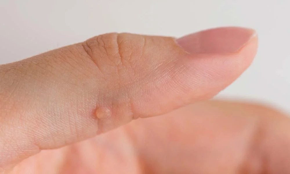 Warts | Treat Fungal Infections Today — SKN Dermatology - Physician ...