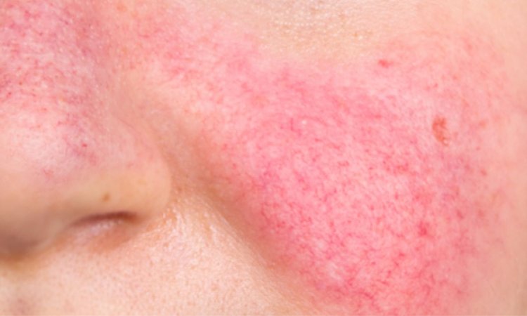 Rosacea: Types, Triggers, & Treatments — SKN Dermatology
